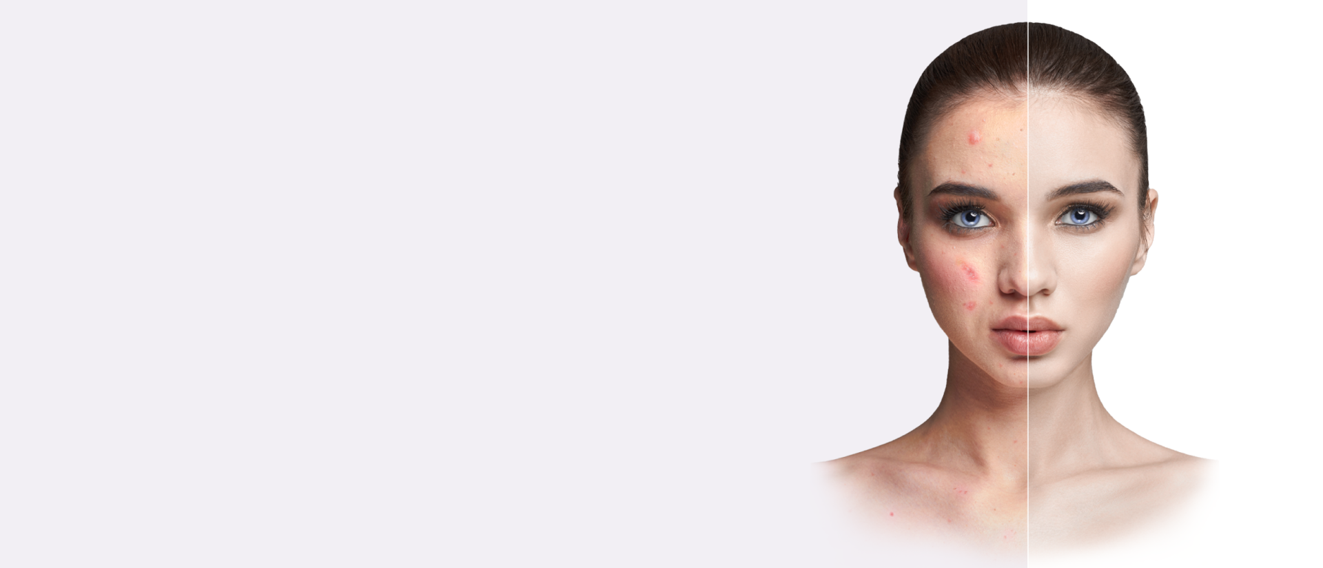 Best Acne Treatment in Hyderabad | Sasha Clinics