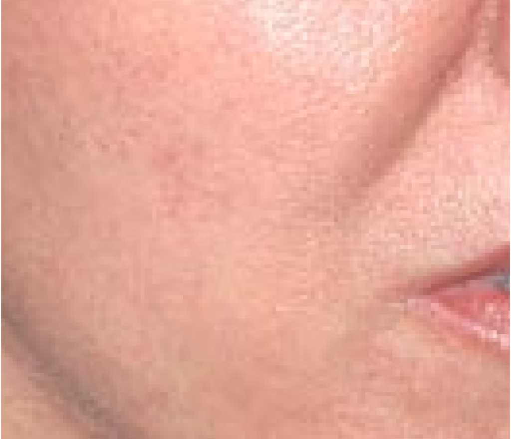 RF Subcision Acne Scar Treatment | Sasha Clinics