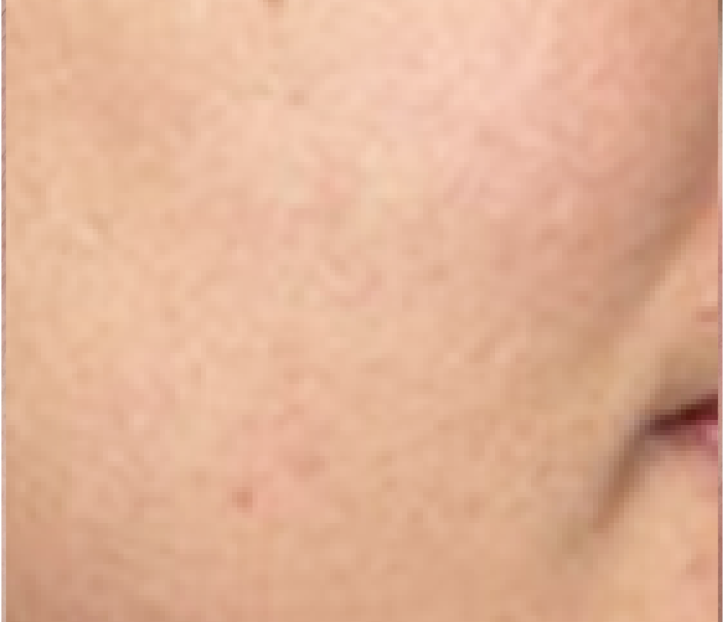 RF Subcision Acne Scar Treatment | Sasha Clinics