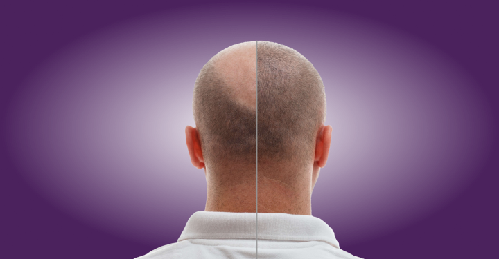 Restore Your Lost Hair with Hair Transplant | Advanced Hair Fall ...