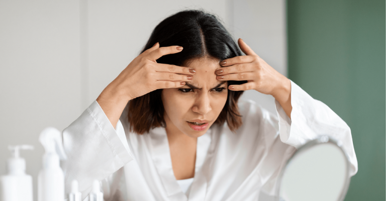 How To Treat Facial Acne Caused By Dandruff? Sasha Clinics