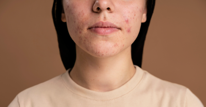 Everything to Know About Dermal Fillers for Acne Scars | Sasha Clinics