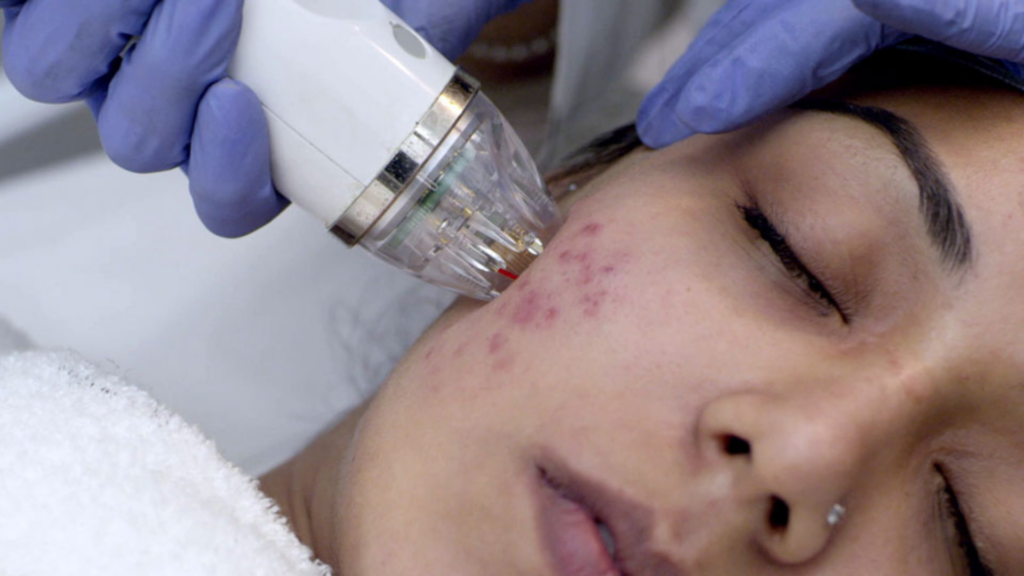 How to remove acne marks? - Sasha